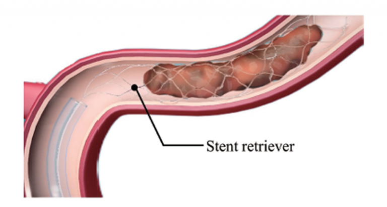Stroke - HeMo Bioengineering Limited