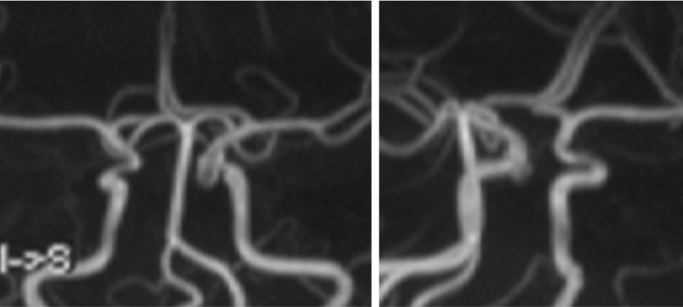 Using 6F TracLine™ catheter in the treatment of aneurysms - HeMo ...