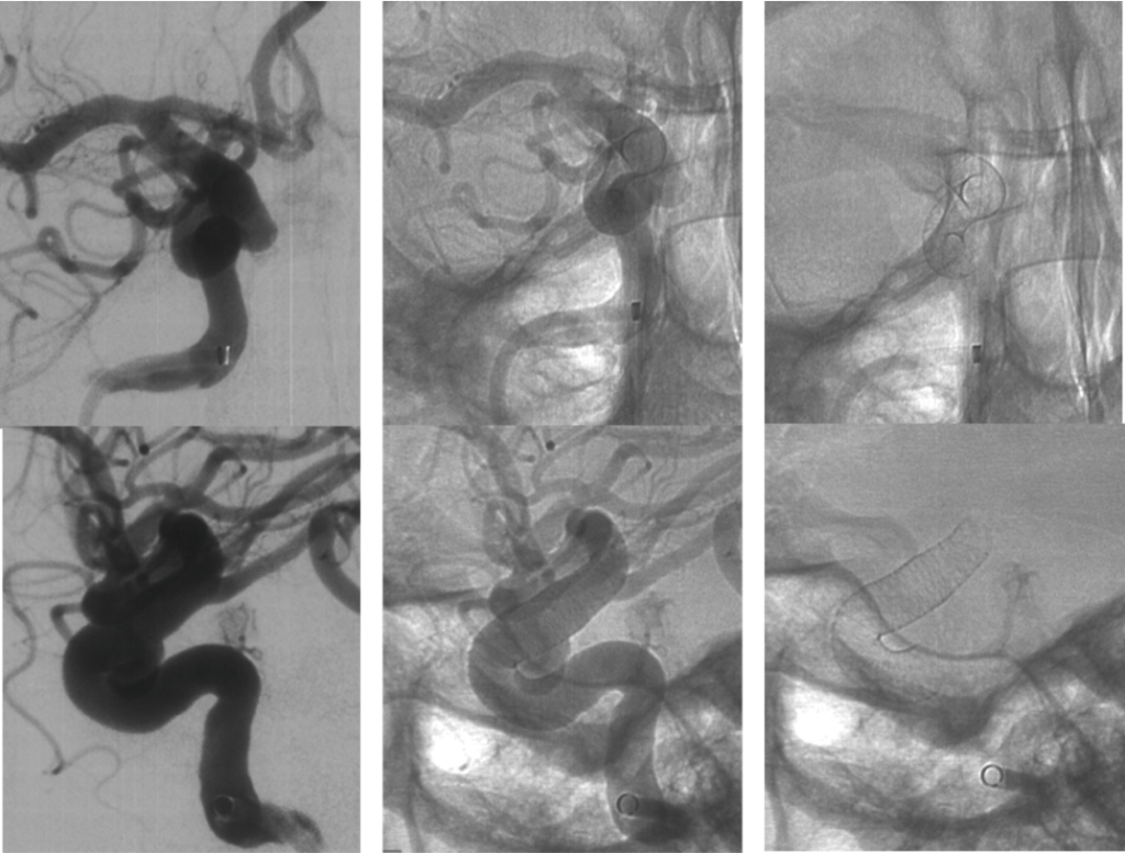 Using 6F TracLine™ catheter in the treatment of aneurysms - HeMo ...